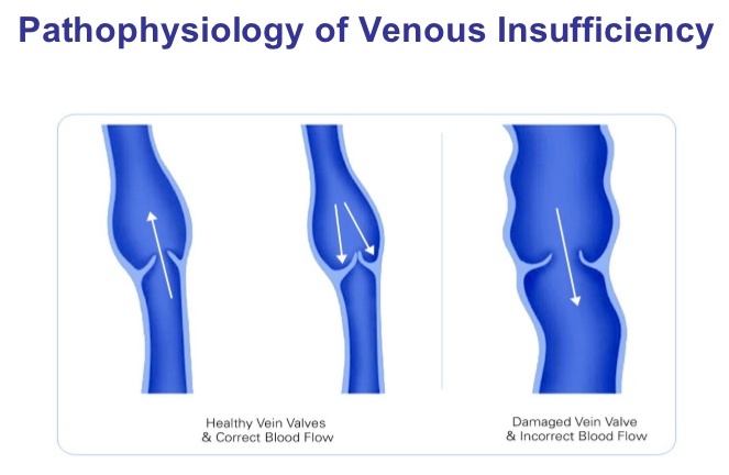 VENOPROTEKT 6 MIX VAR 1 Kompozitna formula kod hronične venske ...