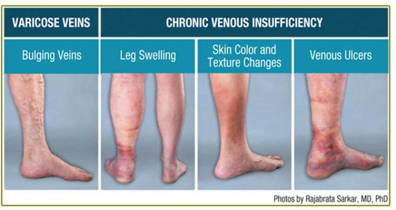 VENOPROTEKT 6 MIX VAR V Kompozitna formula kod hronične venske ...